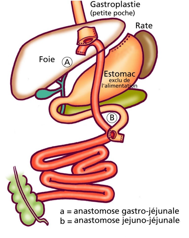 UPSOM - Bypass Gastrique Centre de Chirurgie Viscérale et de l'Obésité ...
